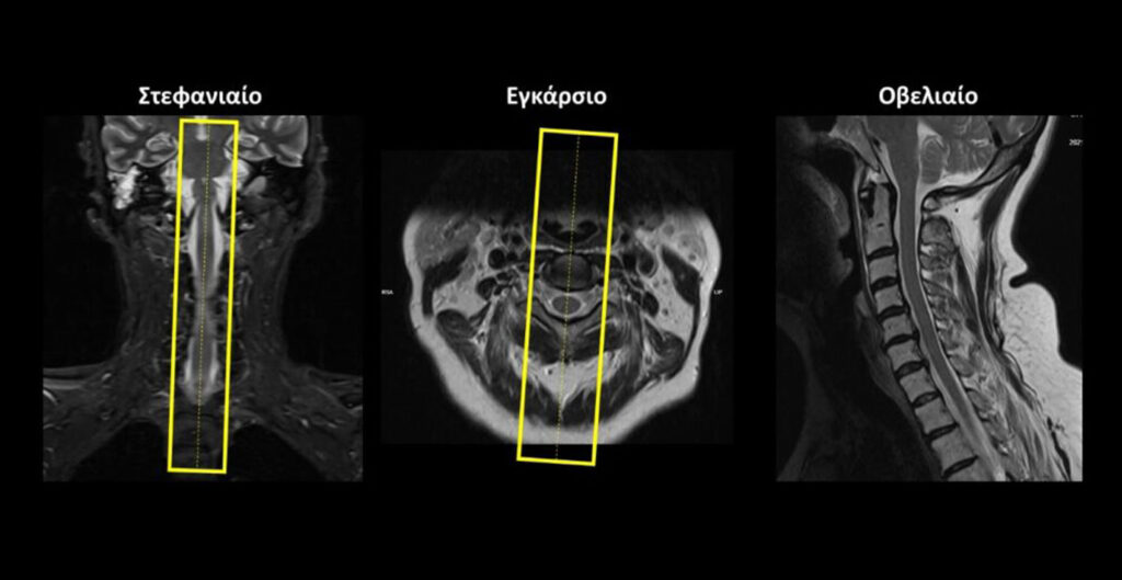 MRI Rad | Μαγνητική Τομογραφία Αυχενικής Μοίρας Σπονδυλικής Στήλης (ΑΜΣΣ)