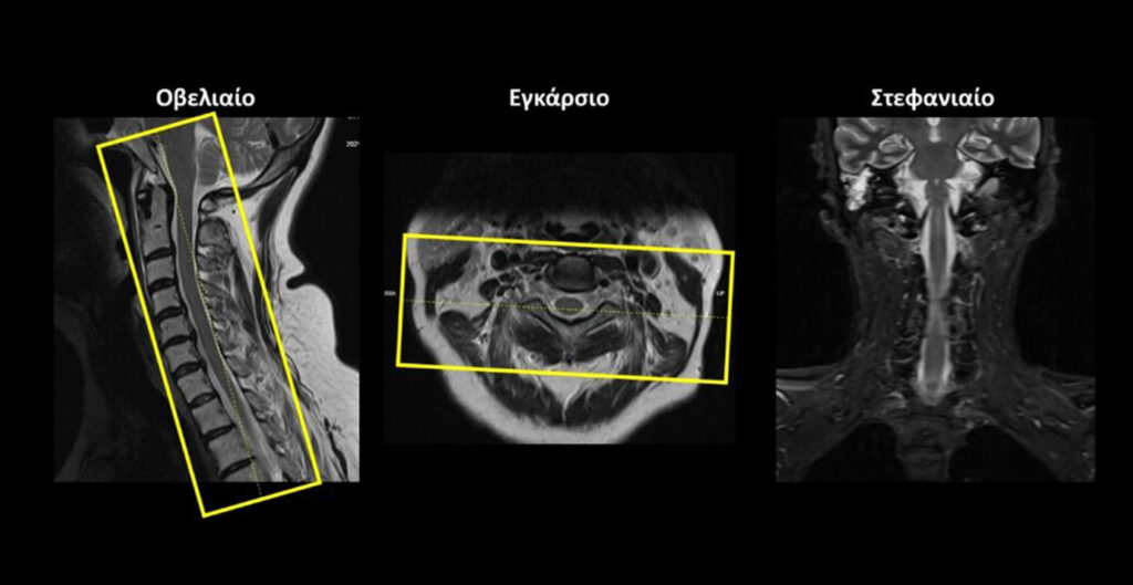 MRI Rad | Μαγνητική Τομογραφία Αυχενικής Μοίρας Σπονδυλικής Στήλης (ΑΜΣΣ)