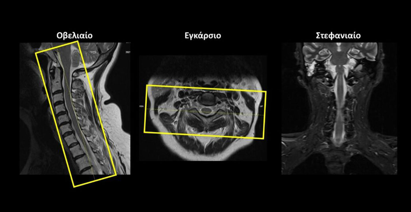 MRI Rad | Μαγνητική Τομογραφία Αυχενικής Μοίρας Σπονδυλικής Στήλης (ΑΜΣΣ)