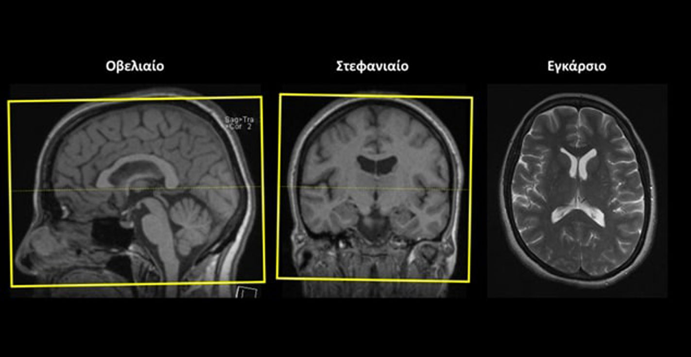 MRI Rad | Μαγνητική Τομογραφία Οφθαλμικών Κόγχων