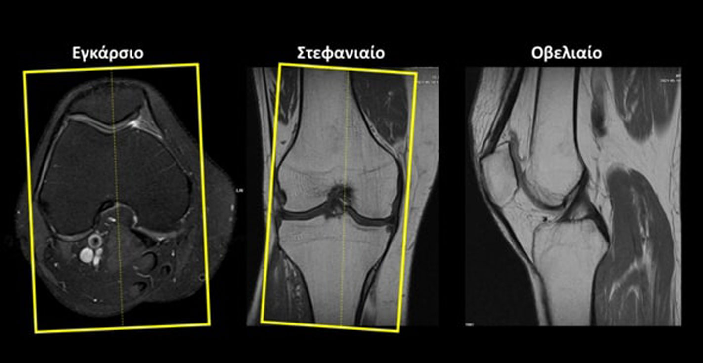 MRI Rad | Μαγνητική Τομογραφία Γόνατος