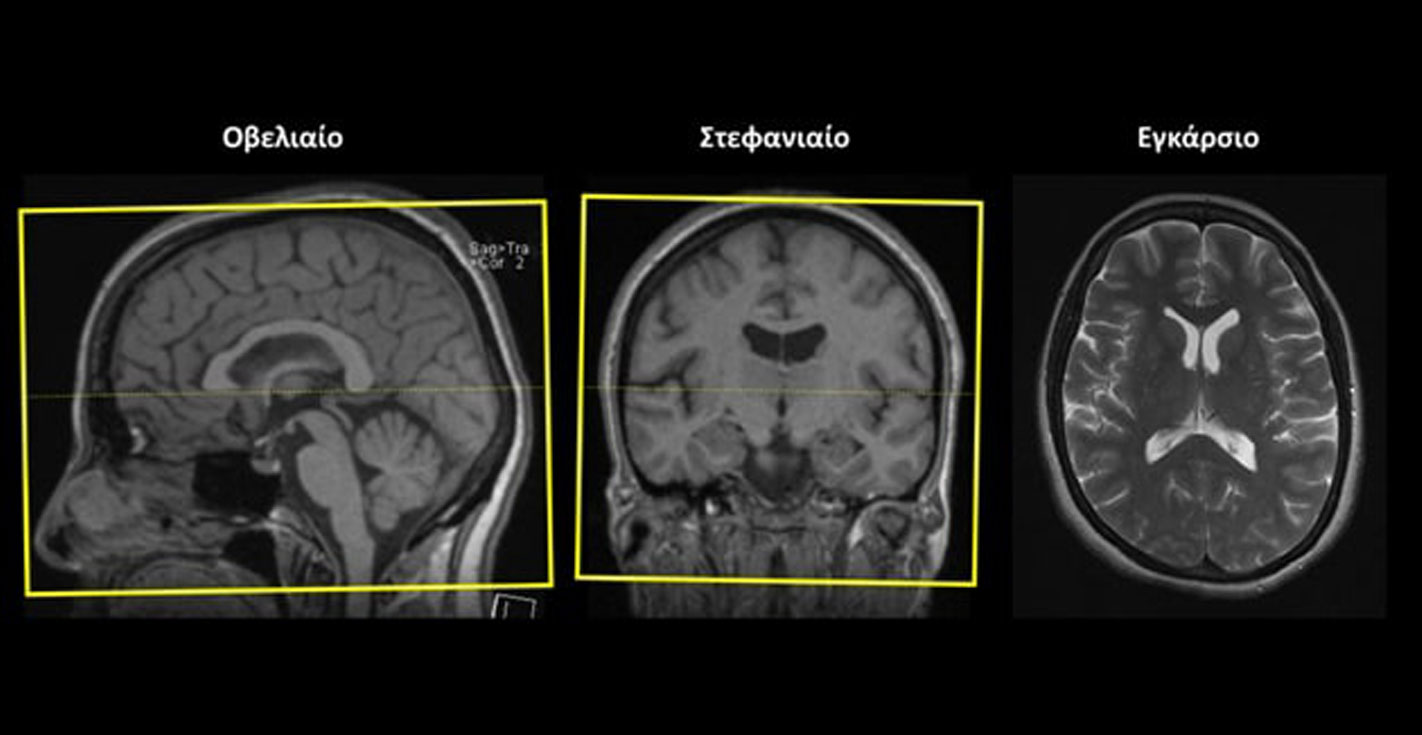 MRI Rad | Μαγνητική Τομογραφία Εγκεφάλου (ρουτίνα)