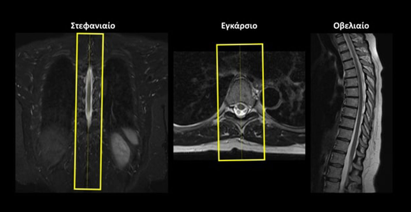 MRI Rad | Μαγνητική Τομογραφία Θωρακικής Μοίρας Σπονδυλικής Στήλης (ΘΜΣΣ)