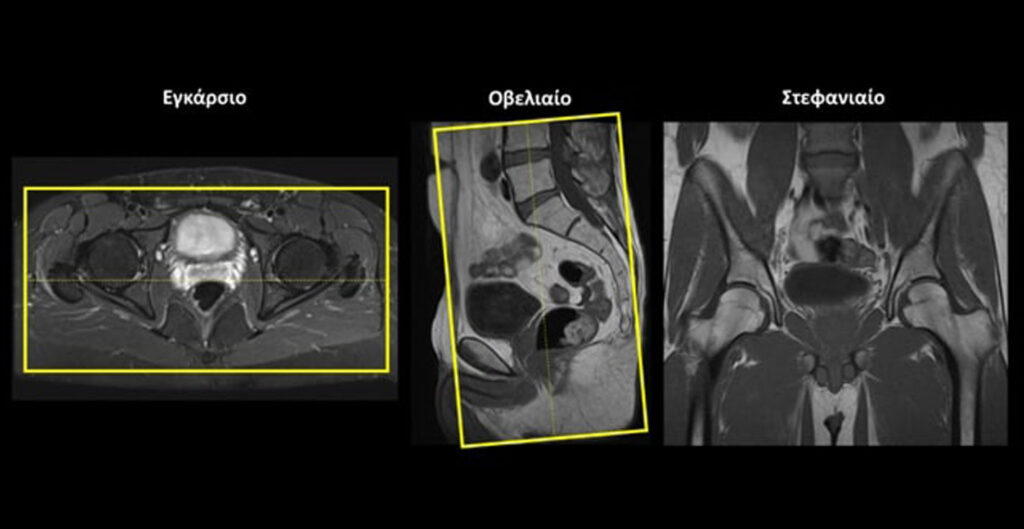 MRI Rad | Μαγνητική Τομογραφία Λεκάνης – Οστέινης Πυέλου