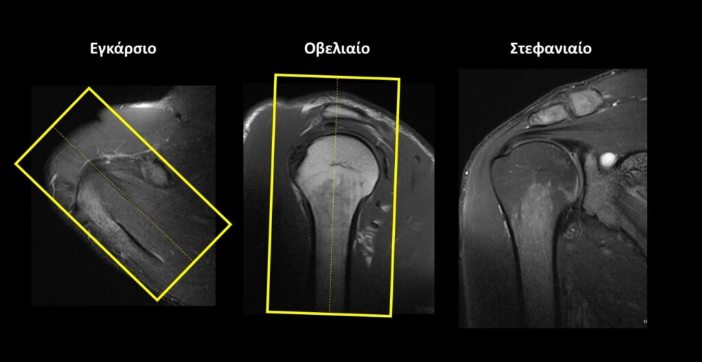 MRI Rad | Μαγνητική Τομογραφία Ώμου
