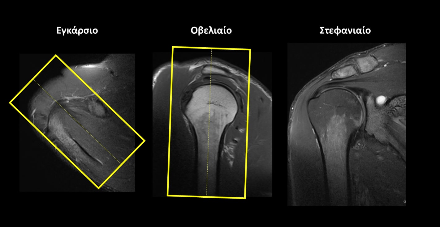 MRI Rad | Μαγνητική Τομογραφία Ώμου