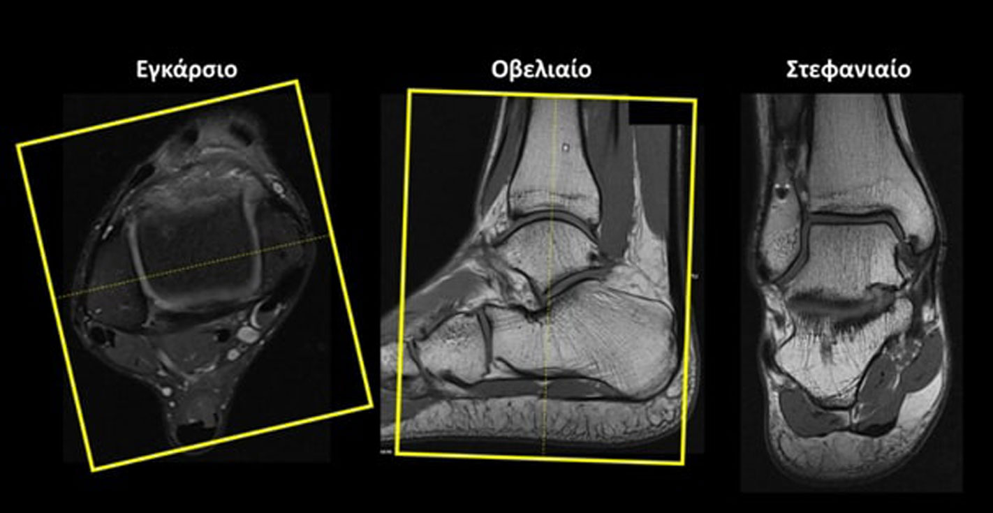 MRI Rad | Μαγνητική Τομογραφία Ποδοκνημικής (ΠΔΚ) Άρθρωσης