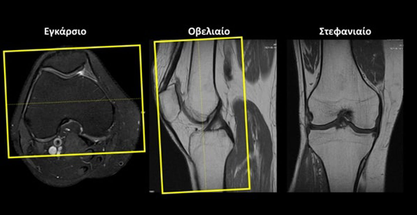 MRI Rad | Μαγνητική Τομογραφία Γόνατος