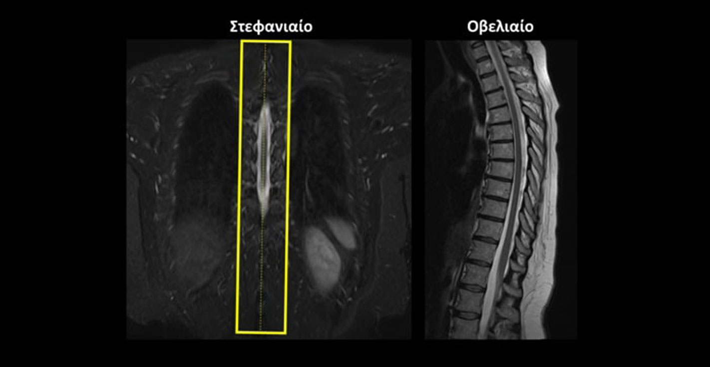 MRI Rad | MRI Νωτιαίου Μυελού