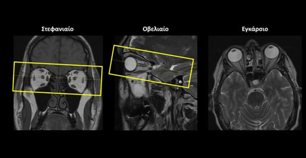 MRI Rad | Μαγνητική Τομογραφία Οφθαλμικών Κόγχων