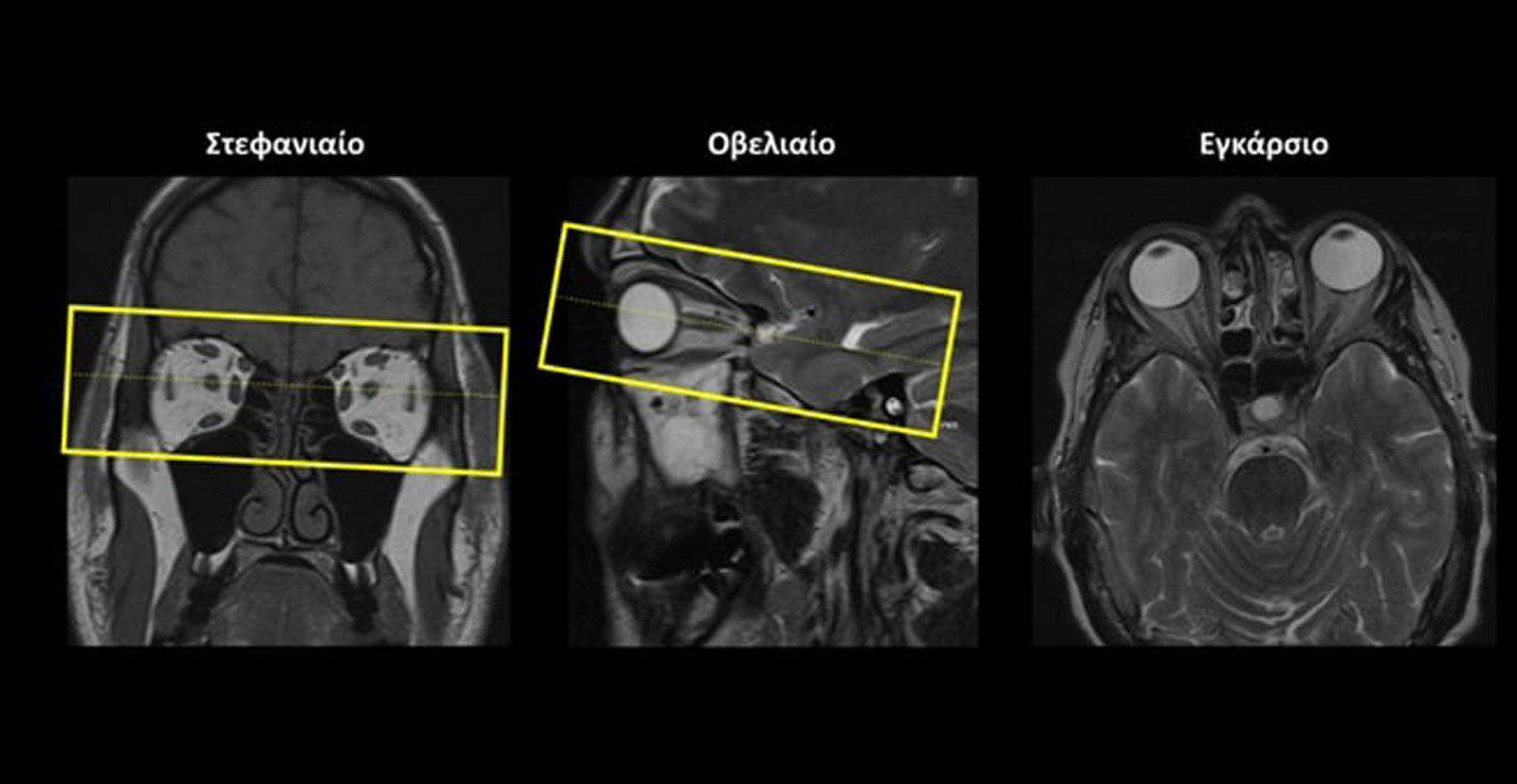 MRI Rad | Μαγνητική Τομογραφία Οφθαλμικών Κόγχων