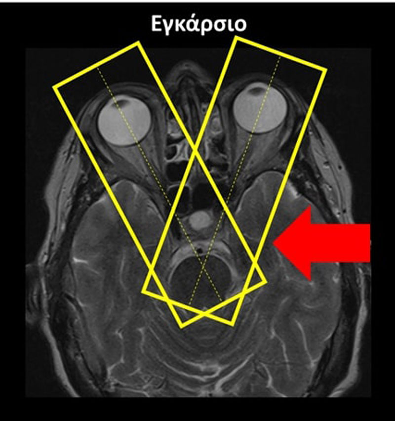 MRI Rad | Μαγνητική Τομογραφία Οφθαλμικών Κόγχων