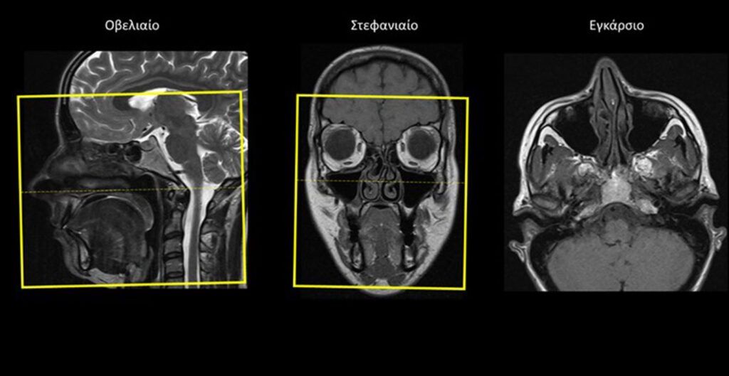 MRI Rad | MRI Σπλαχνικού Κρανίου (facial)