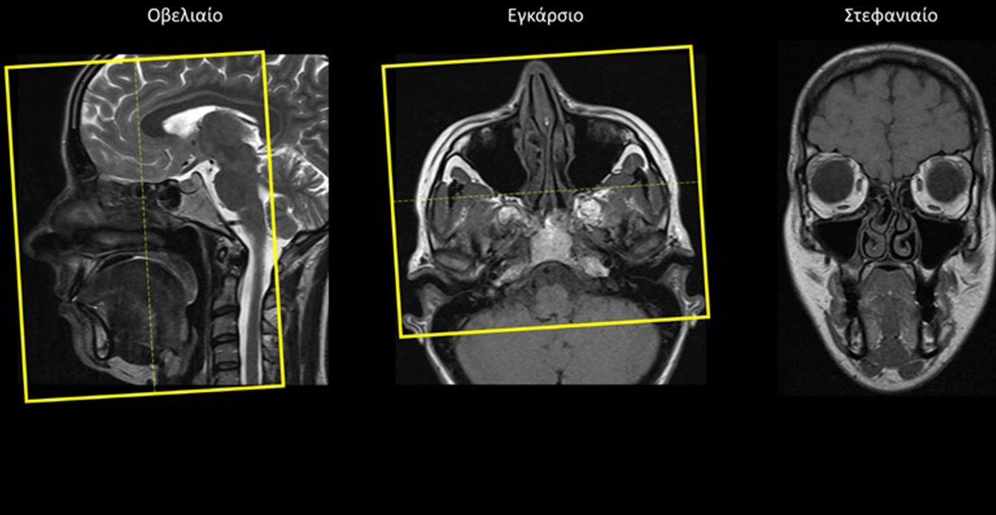 MRI Rad | MRI Σπλαχνικού Κρανίου (facial)