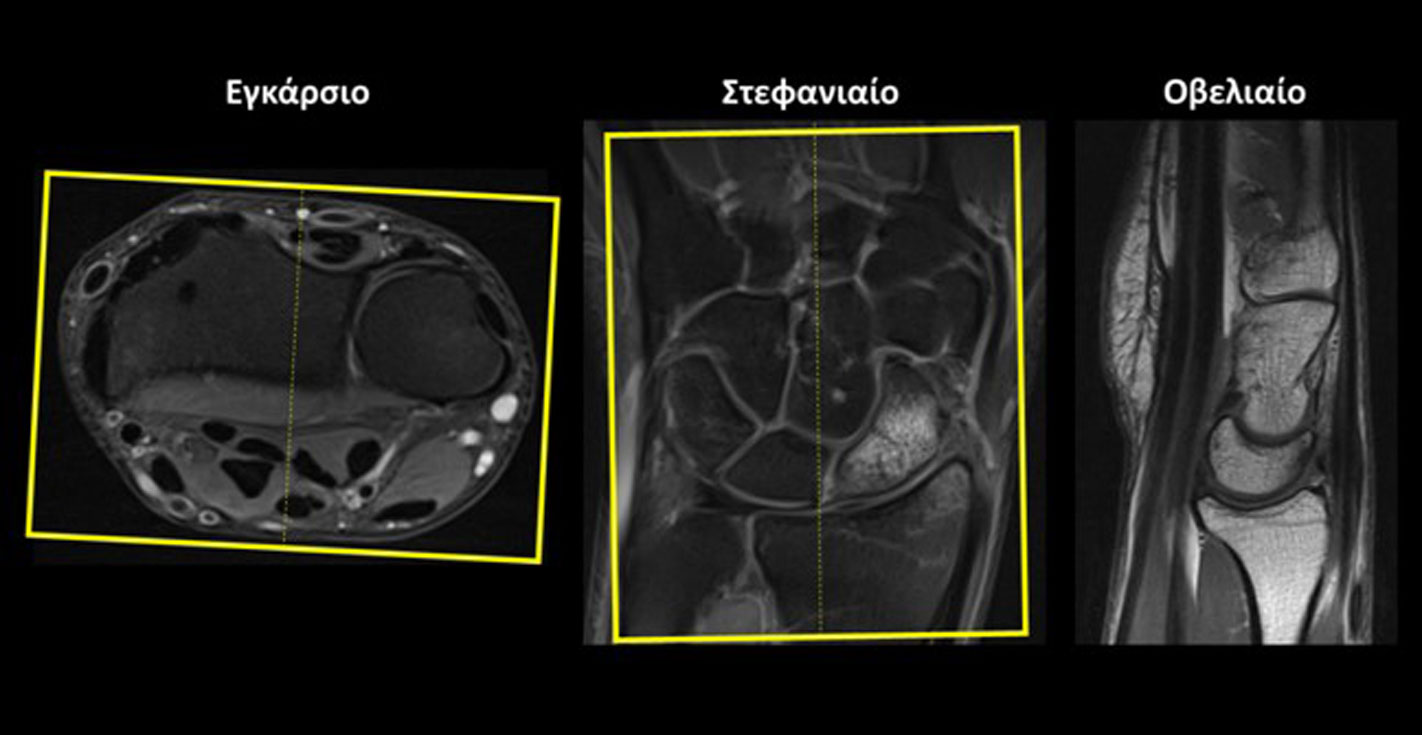 MRI Rad | Μαγνητική Τομογραφία Πηχεοκαρπικής (ΠΧΚ) Άρθρωσης