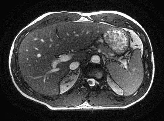 MRI Rad | Ακολουθία παλμών Rewound Gradient Echo (Rewound GRE/ GRASS ...