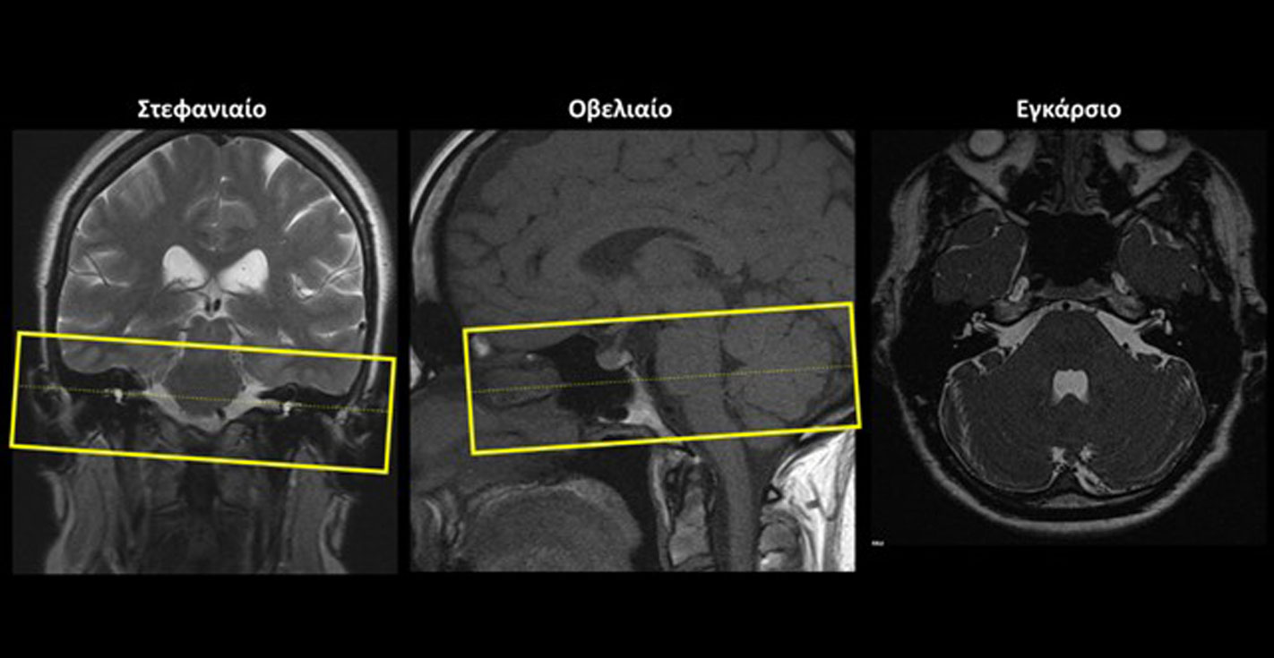 MRI Rad | Μαγνητική Τομογραφία Λιθοειδών – Έσω Ακουστικών Πόρων