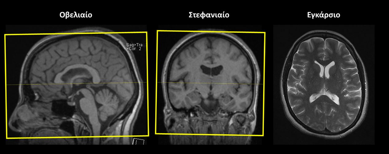 MRI Rad | Μαγνητική Αγγειογραφία / MRA Εγκεφάλου (Αρτηριογραφία)