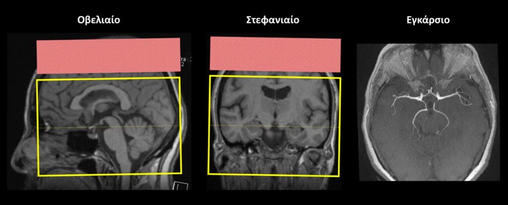 MRI Rad | Μαγνητική Αγγειογραφία / MRA Εγκεφάλου (Αρτηριογραφία)