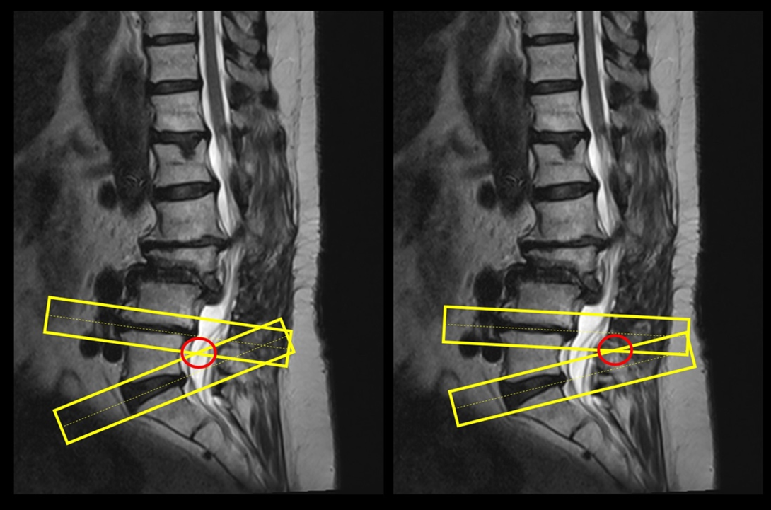 MRI Rad | Τεχνικό σφάλμα Διασταυρούμενης Διέγερσης (Cross-talk ή Slice ...