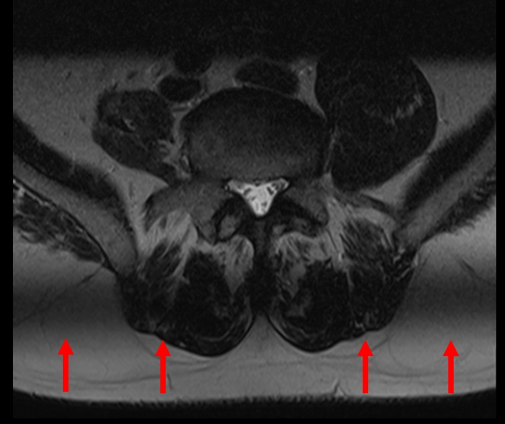 MRI Rad | Τεχνικό σφάλμα Διασταυρούμενης Διέγερσης (Cross-talk ή Slice ...