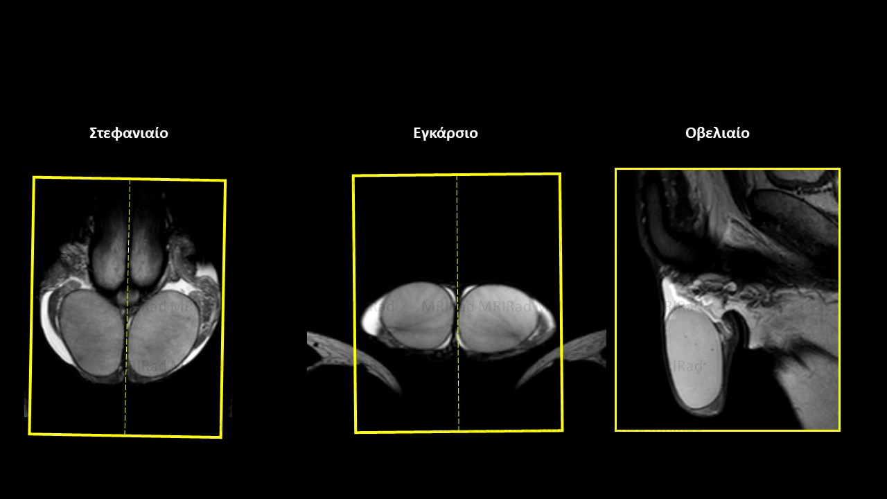 MRI Rad | Μαγνητική Τομογραφία Οσχέου(πολυπαραμετρική)