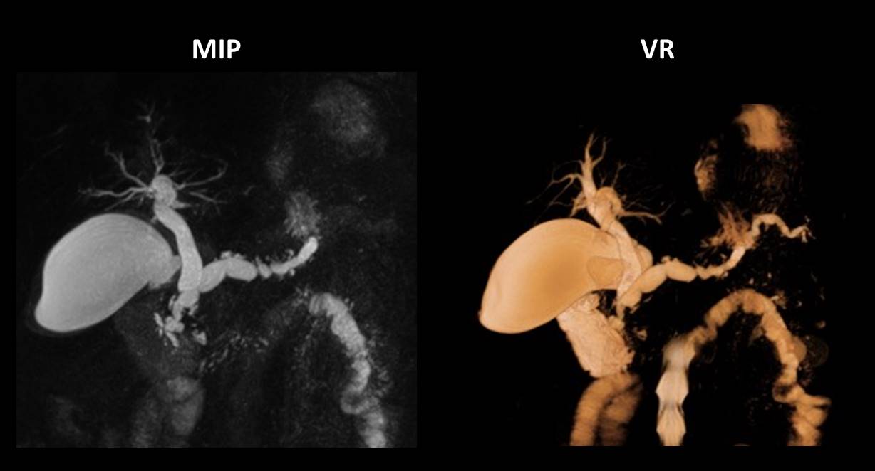 MRI Rad | Μαγνητική χολαγγειοπαγκρεατογραφία (MRCP)